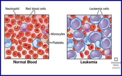 Leukemia – Semua Hal yang Perlu Diketahui Mengenai Jenis Kanker Darah Ini